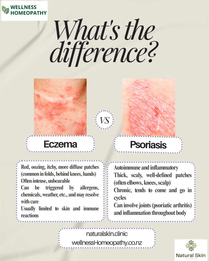What Exactly Is Psoriasis — and How Is It Different from Eczema or ...